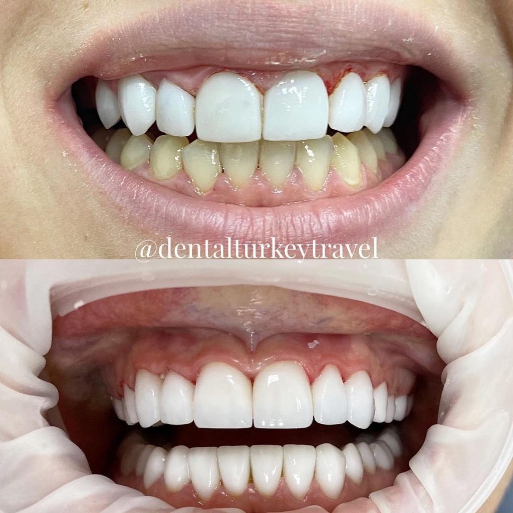 Smile Makeover in Turkey at MedicaSmile