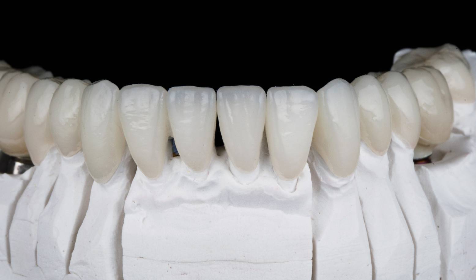 How much does a full set of veneers cost in Turkey?