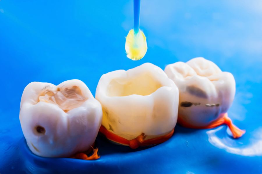 What is a tooth filling? | MedicaSmile