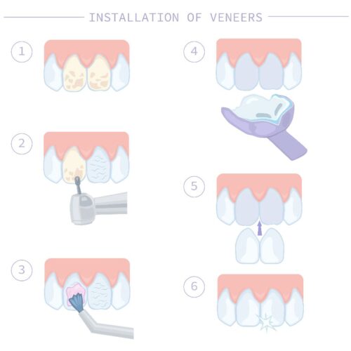 Turkey Veneers Before and After Photos - MedicaSmile
