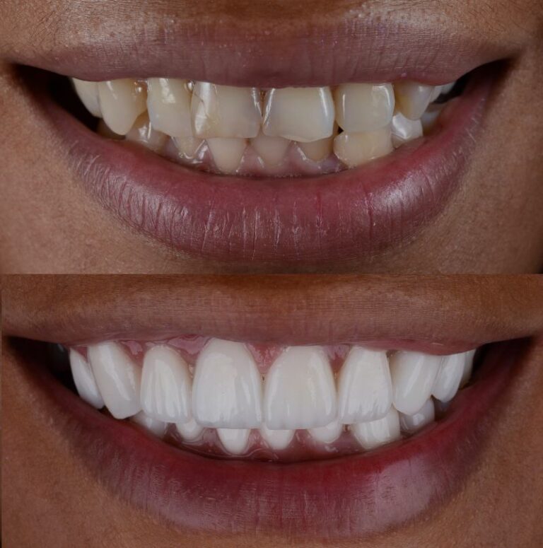 Turkey Veneers Before and After Photos - MedicaSmile