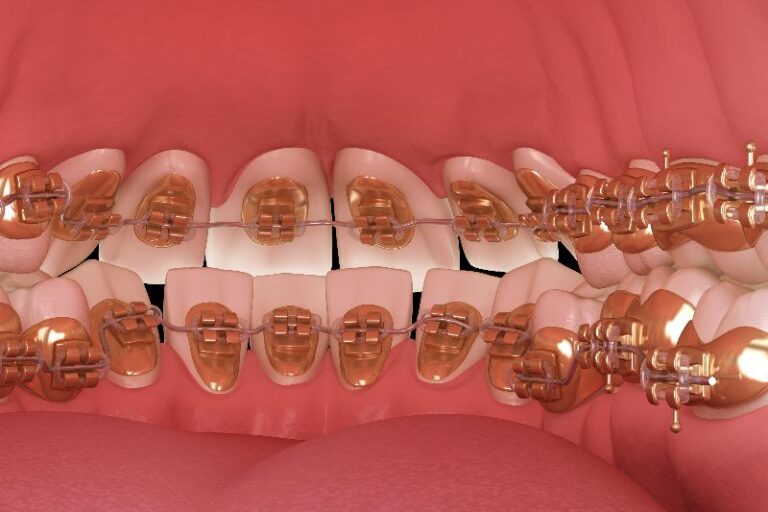 Are Miley Cyrus’ Teeth Real? | MedicaSmile