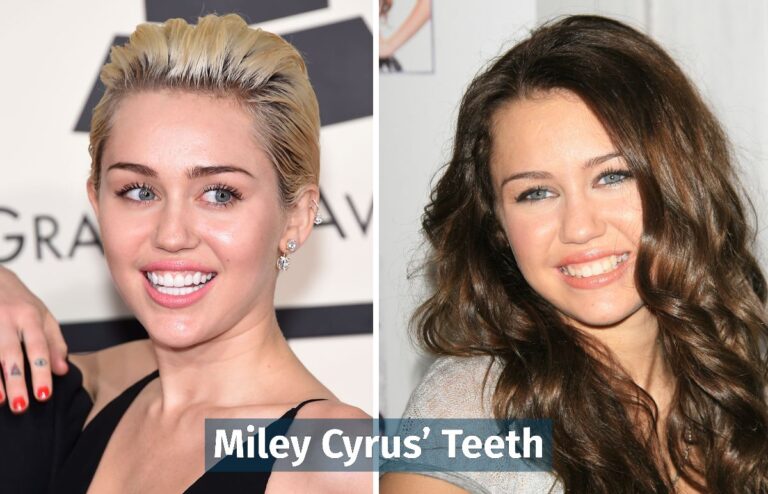 Are Miley Cyrus’ Teeth Real? | MedicaSmile