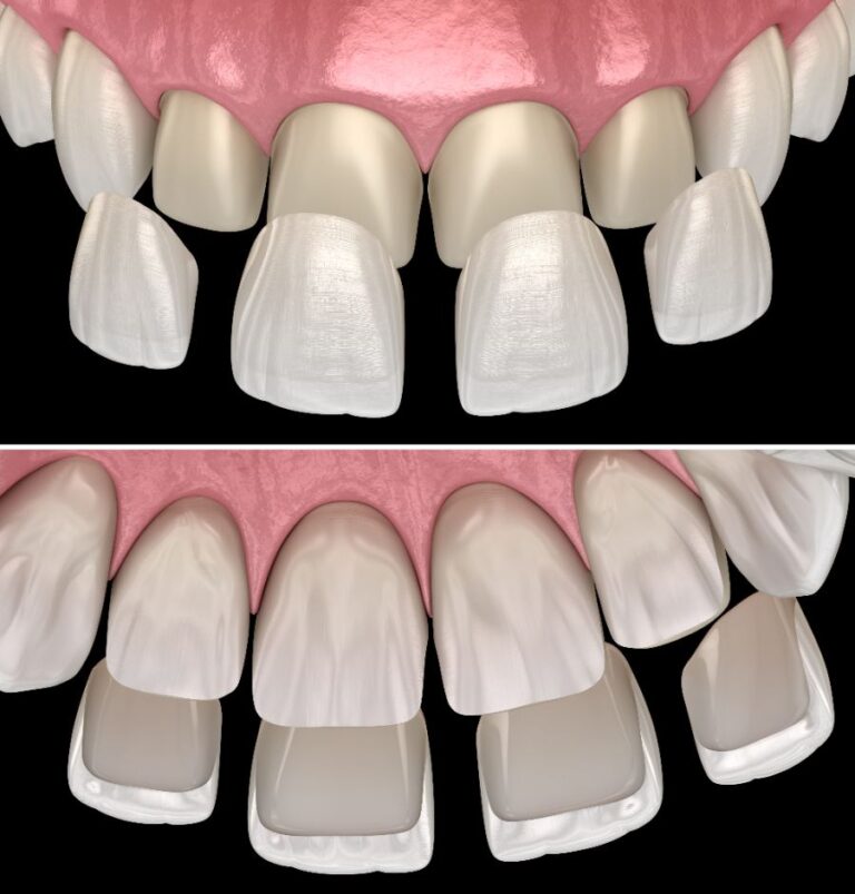 What is the No-Prep Veneers Cost in Turkey?