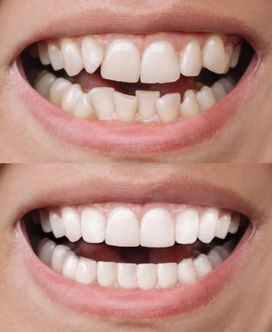 Dental Braces in Turkey: Best Prices, Pros and Types